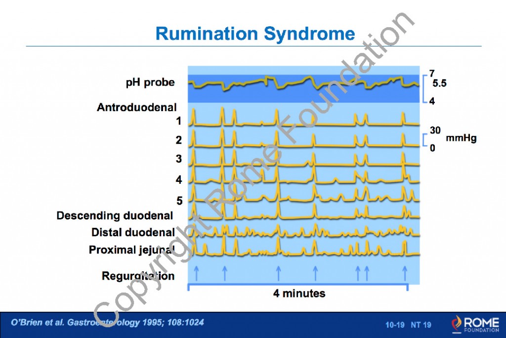 Gastroduodenal 13 – Treatment of Functional Dyspepsia Based on Subgroup – Rome Online
