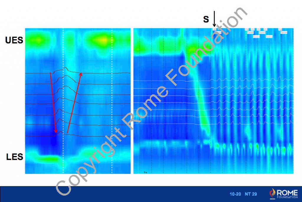 Gastroduodenal 13 – Treatment of Functional Dyspepsia Based on Subgroup – Rome Online
