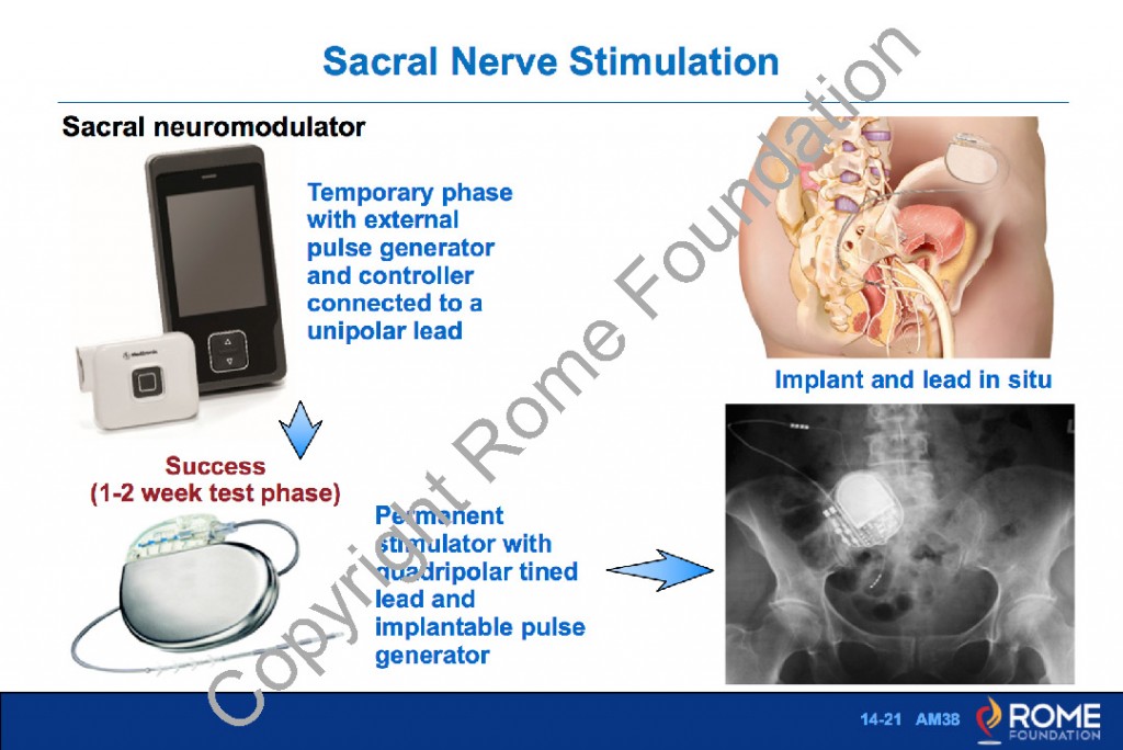 Anorectal 28 – Balloon Expulsion Test – Rome Online