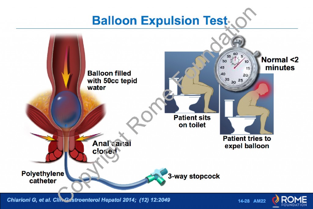 Anorectal 28 – Balloon Expulsion Test – Rome Online