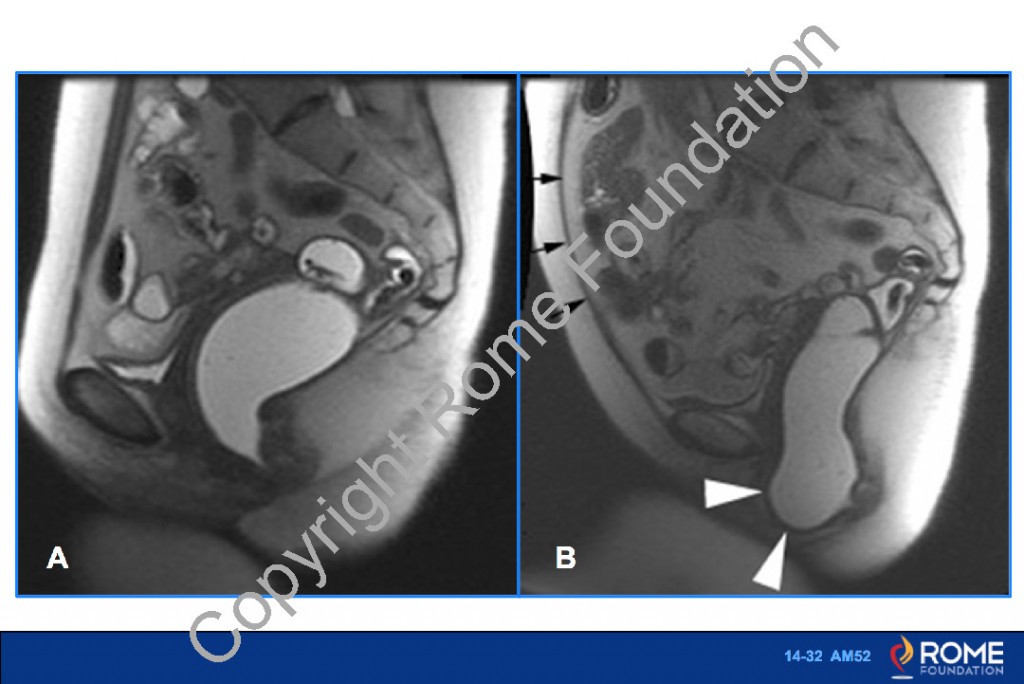 Anorectal 32 – Dynamic MRI Proctography – Rome Online